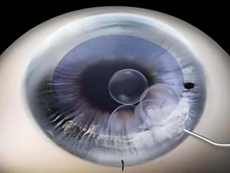 Refractive laser surgery: an advanced vision solution - Dr. Ali Nowrouzi
